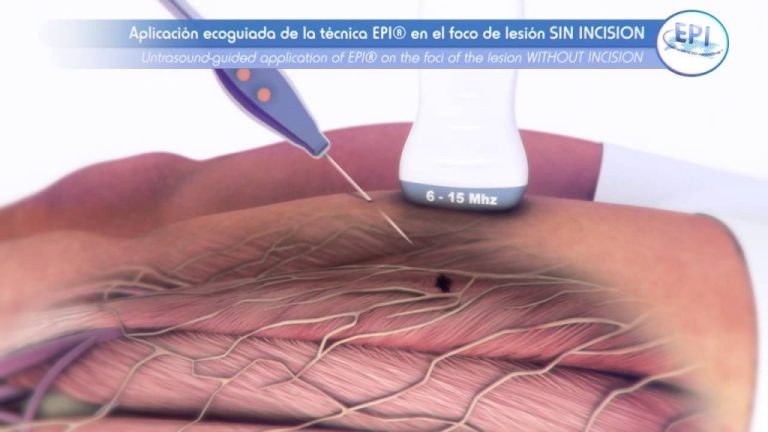 Epi – Electrólisis percutanea intratisular - Clínica Fisiomedicin